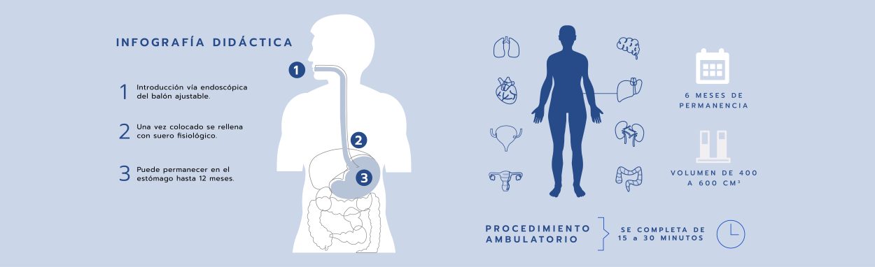 BALON INTRAGASTRICO LEX-BAL – ENDOCARIBE